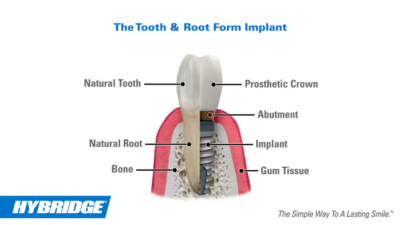 Hybridge Dental Implants | Serving Broome, Tompkins & Tioga Counties